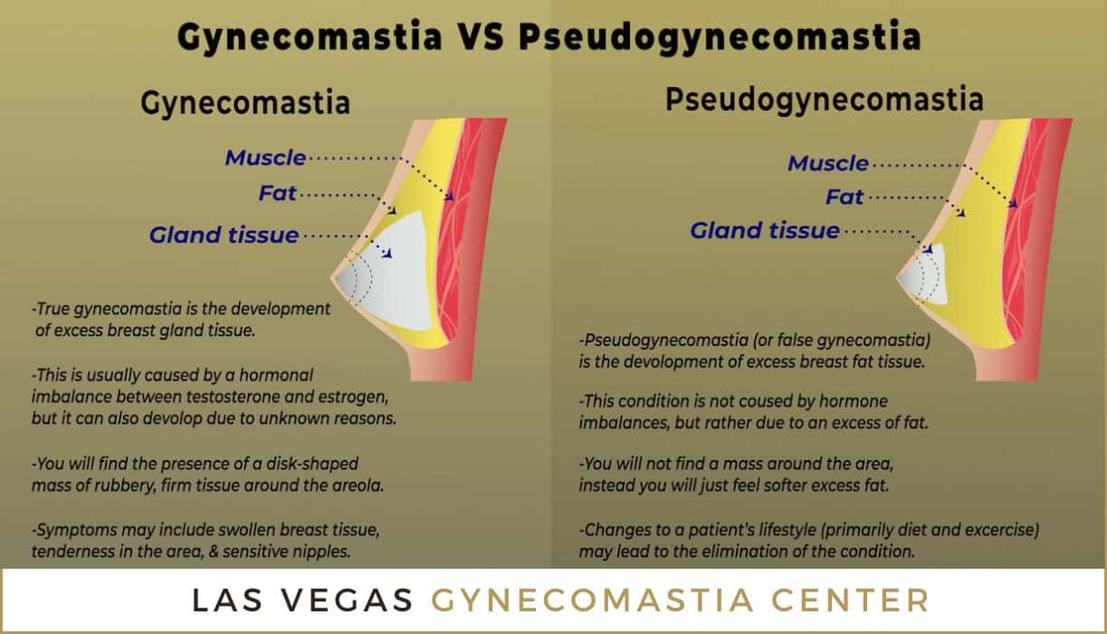 Pseudogynecomastia Surgery at Las Vegas Gynecomastia Center